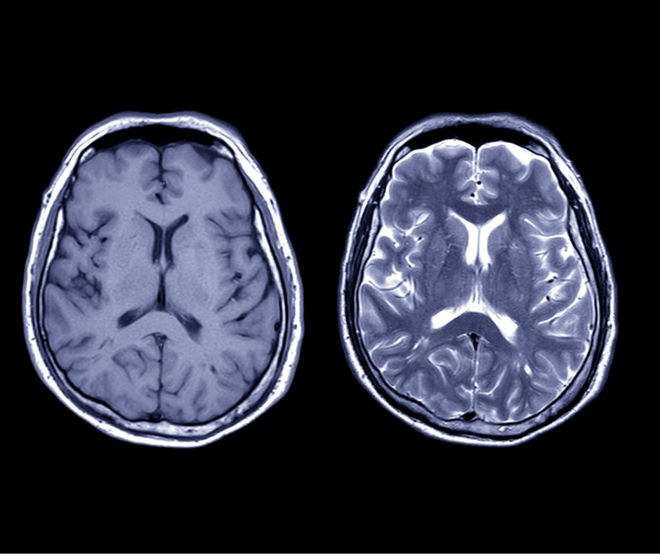 Unexpected Finding: In-Person Assessment Study of Former NFL Players ...